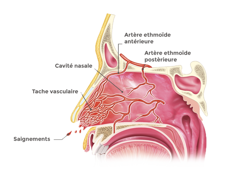 Épistaxis ou saignement de nez - Brothier