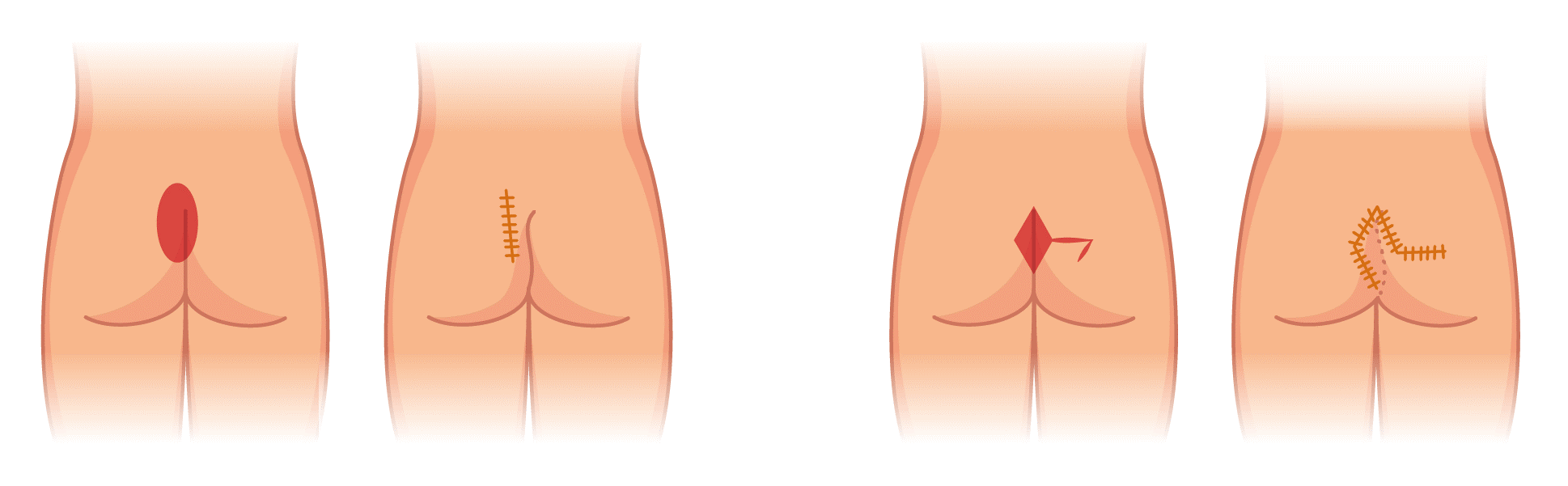 Le kyste sacro-coccygien ou Sinus pilonidal - Brothier